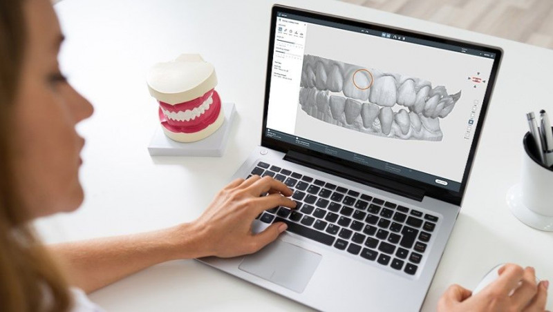 VISION: Clear Aligner Treatment Planning